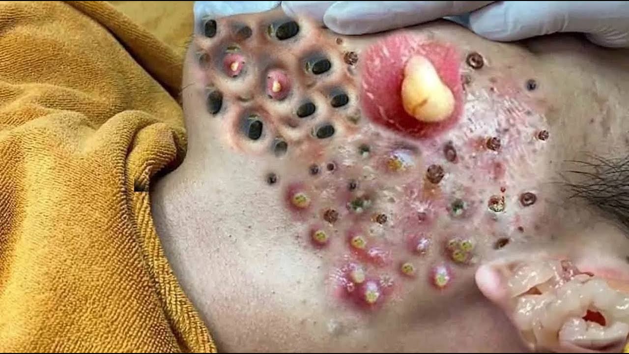 Everything You Need to Know About Whiteheads – 90schilhood